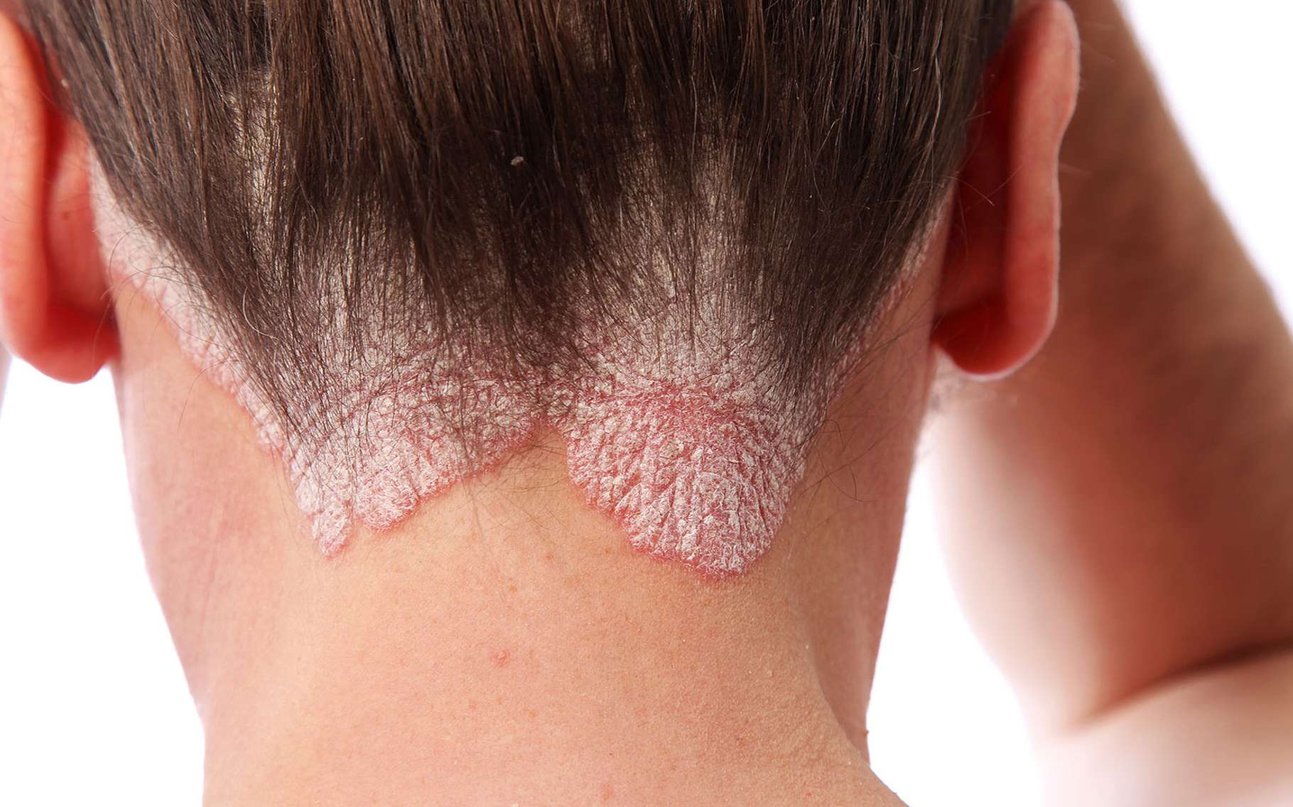 Penyakit Kulit Psoriasis: Panduan Lengkap - Sakura Sehat